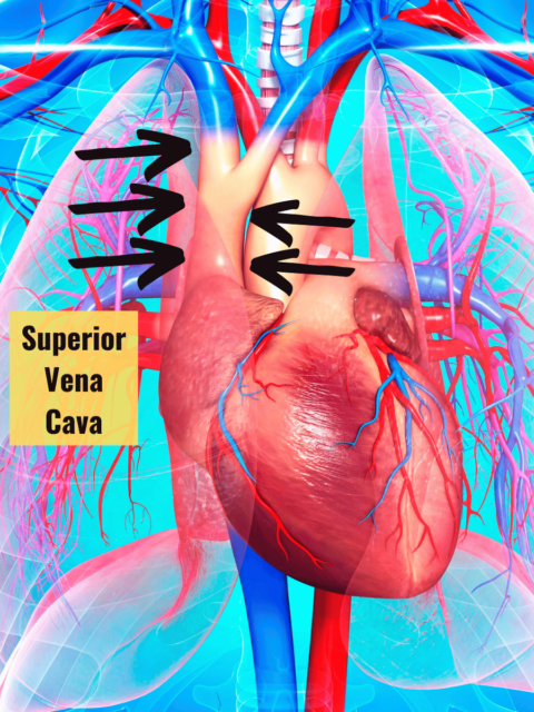 Mastering CVP Monitoring: Setup, Understanding, and Best Practices ...